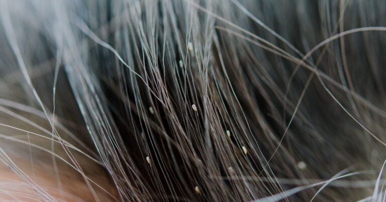 How to Tell if You Have Lice by Yourself: Lice Detection Tips