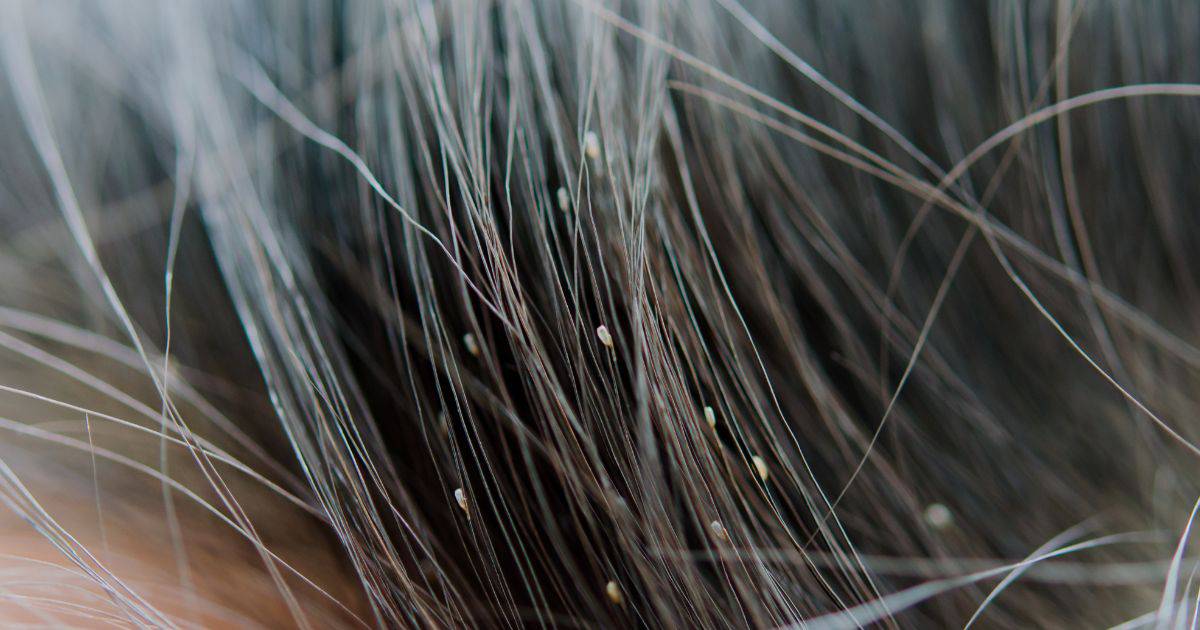 How to Tell if You Have Lice by Yourself: Lice Detection Tips