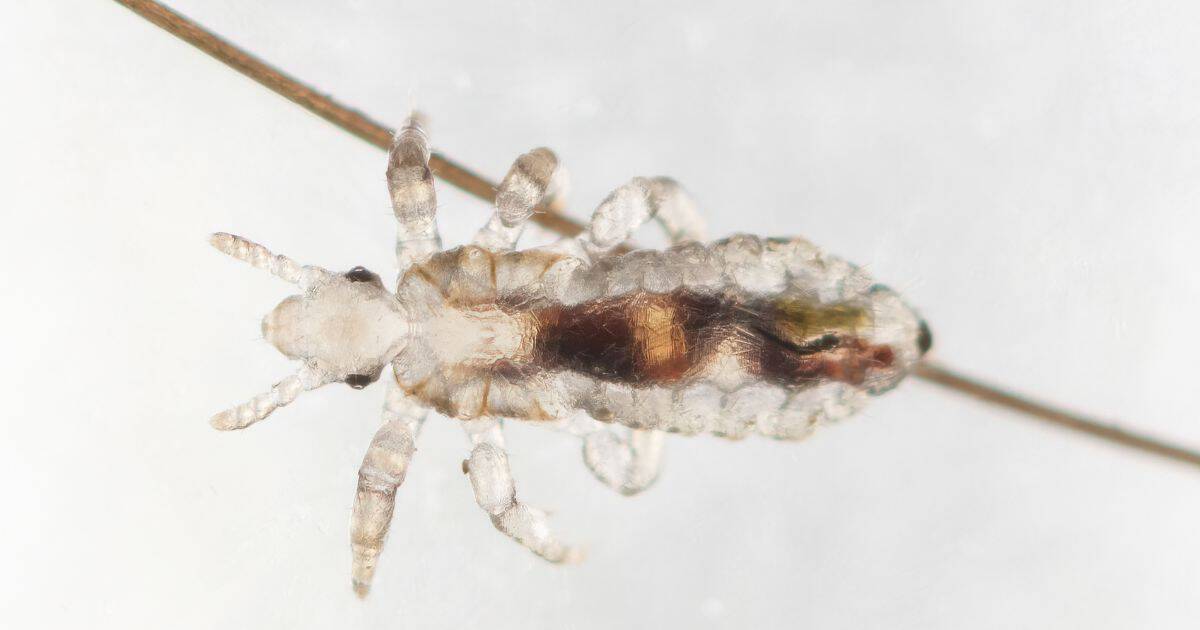Do Lice Prefer a Certain Blood Type? Your Questions Answered